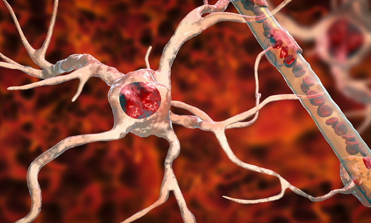 Upper Motor Neuron Disease Definition - Infoupdate.org Upper Motor Neuron Disease Definition - Infoupdate.org