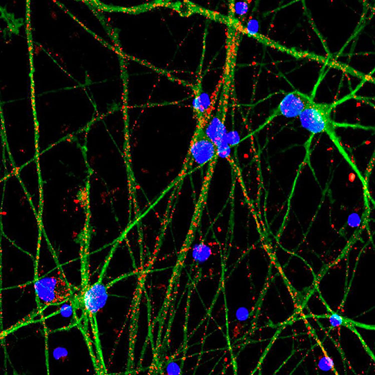 Using in vitro human disease cell models in drug discovery