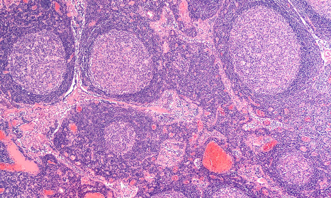 Lymph node metastases may not always be source of cancer's spread Lymph node metastases may not always be source of cancer's spread