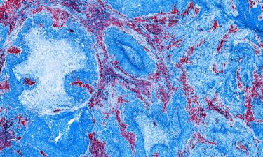 UV light microscope proves useful diagnostic tool for pathologists