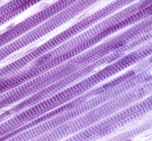 Duchenne muscular dystrophy (DMD) - News, Articles, Whitepapers - Drug ...