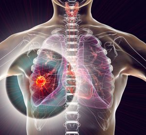 lung squamous carcinoma (LUSC) - News, Articles, Whitepapers - Drug ...