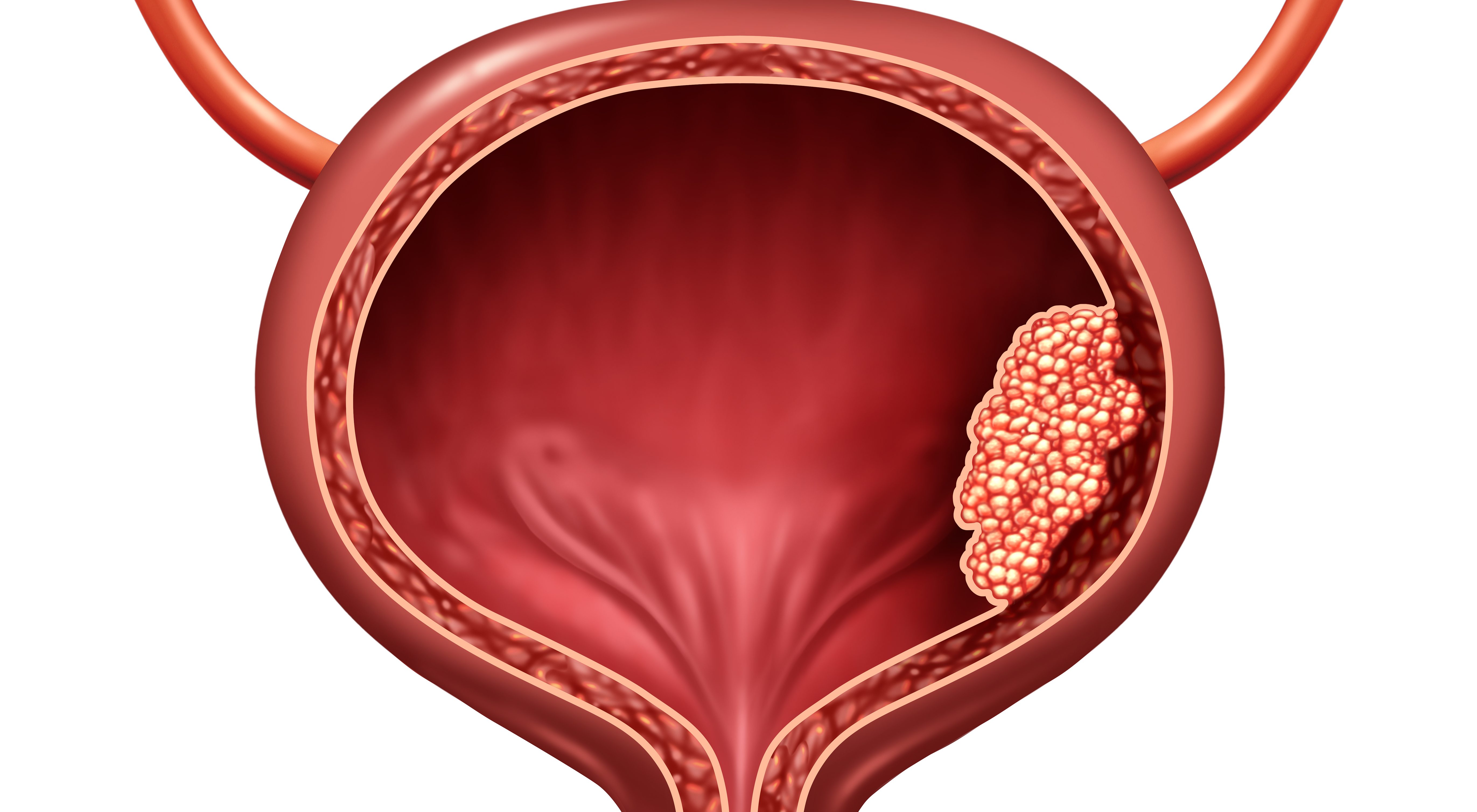 Virus-mimicking LENN nanoparticles deliver mRNA to bladder cancer cells ...