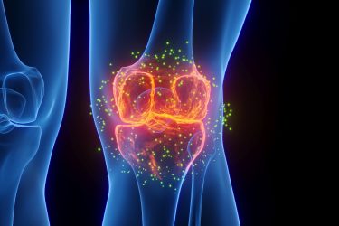 Injectable gel shows promise for osteoarthritis treatment