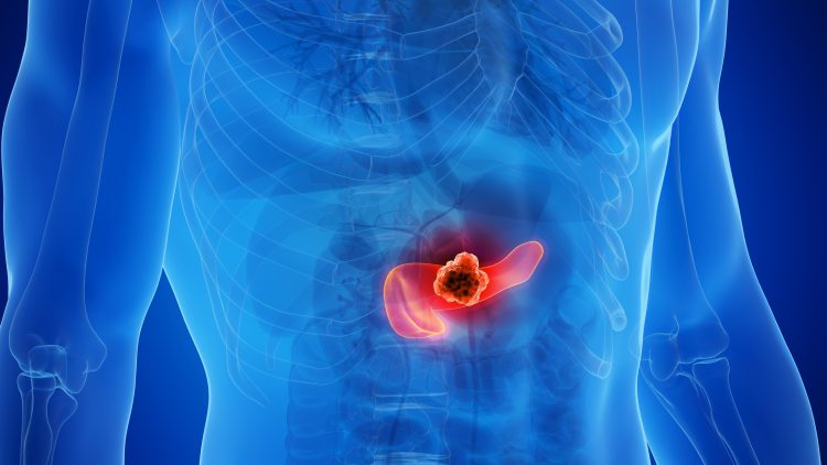 Drug trio found to block tumour resistance in pancreatic cancer - Drug ...